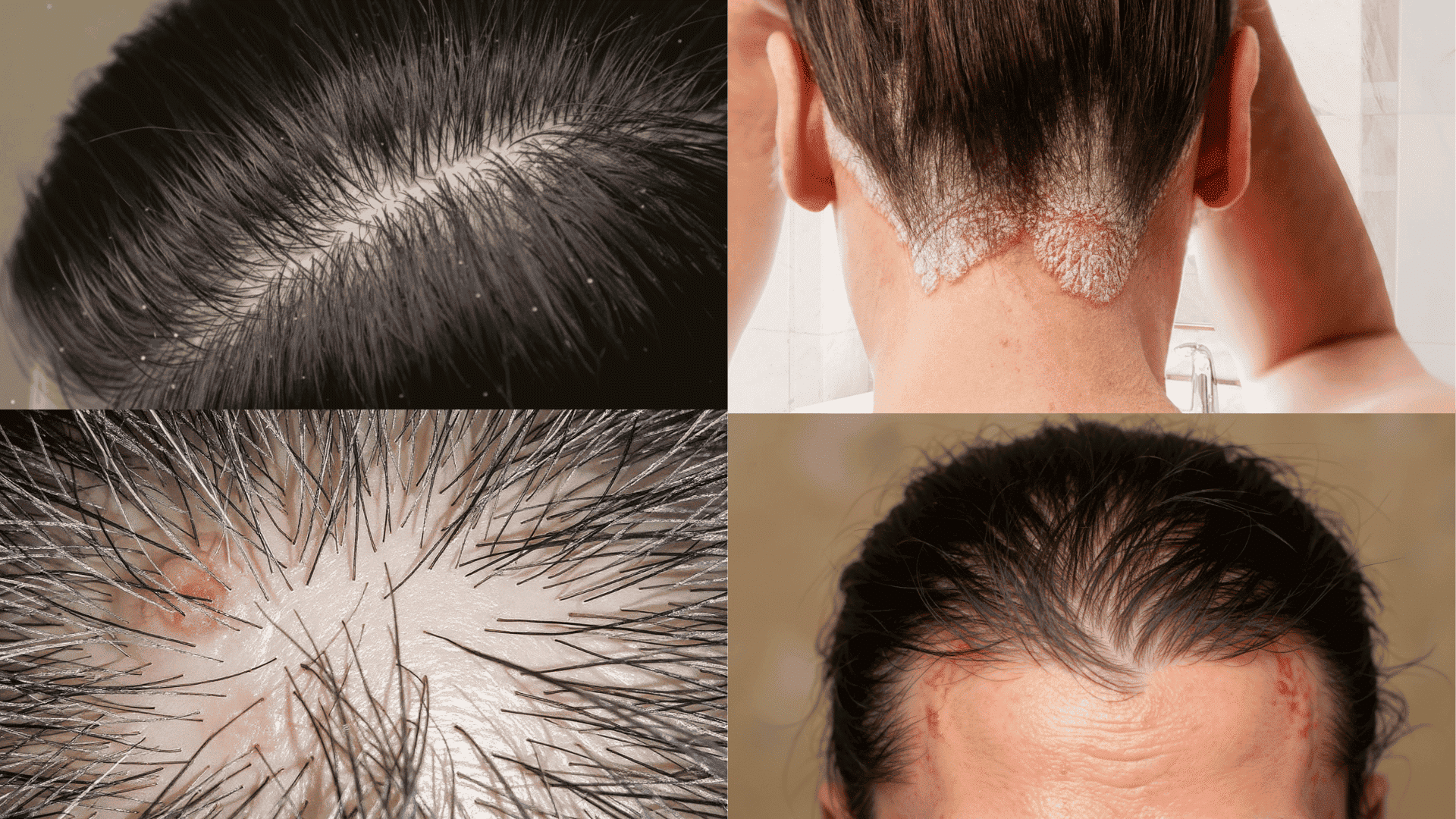 Recurring Scab on Scalp in Same Spot Explained - Style Weekender