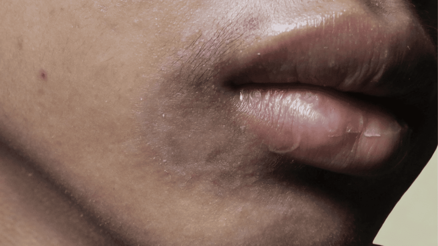 What Causes Hyperpigmentation Around Mouth? - Style Weekender