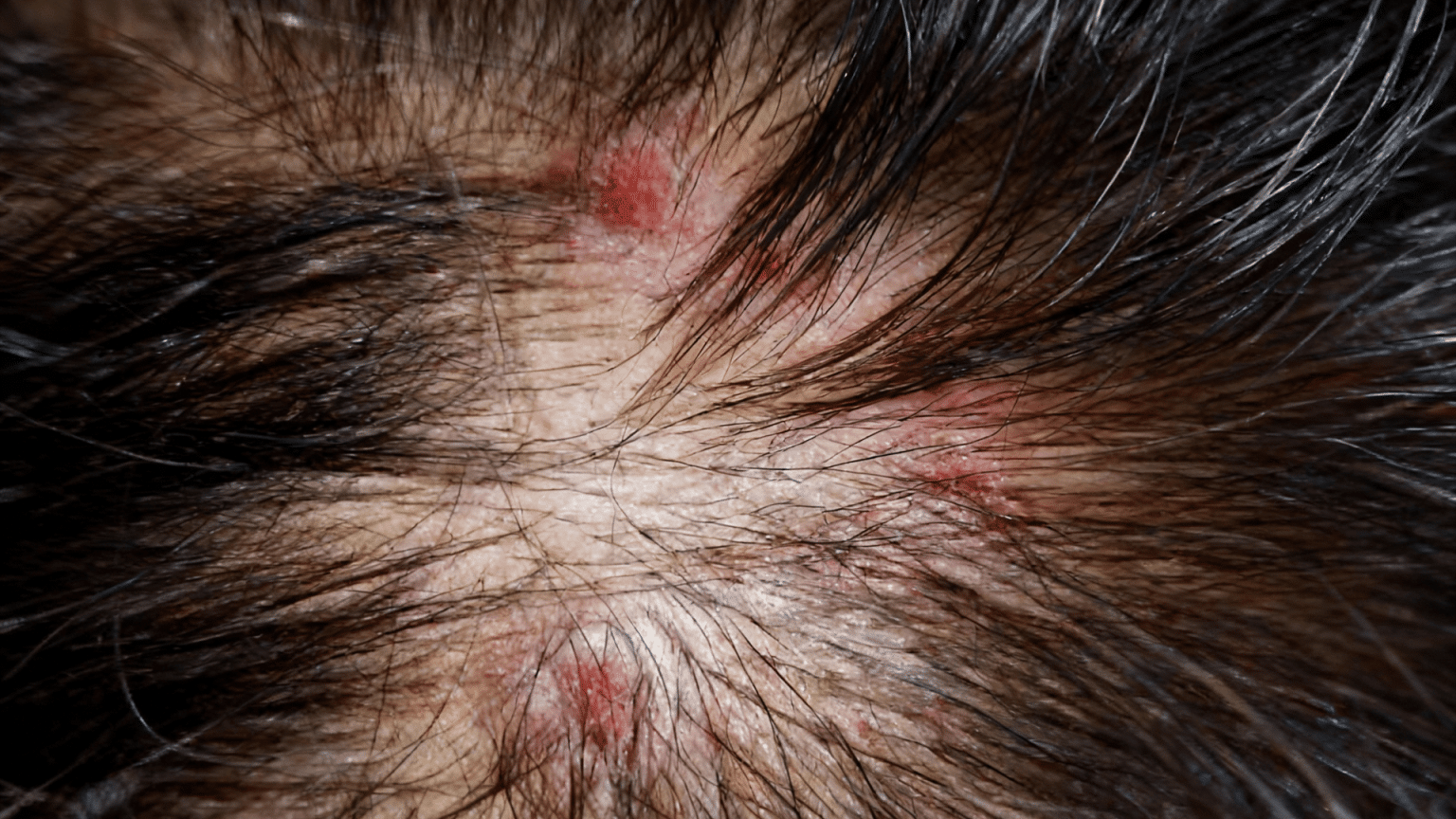 Recurring Scab on Scalp in Same Spot Explained - Style Weekender